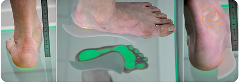 HALLUX-VALGUS2 - Connaissance & Evolution